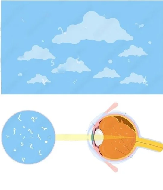 Treat Eye Floaters | Know the Causes, Symptoms & Diagnosis